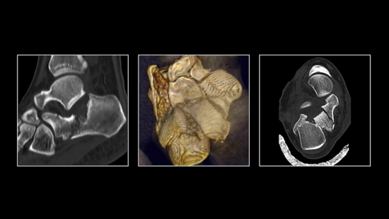 Calcaneus Fractures : OrthoPedia