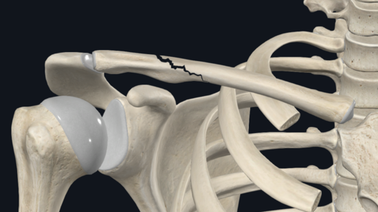 Clavicle Fractures : OrthoPedia
