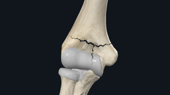 Distal Humerus Fractures : OrthoPedia
