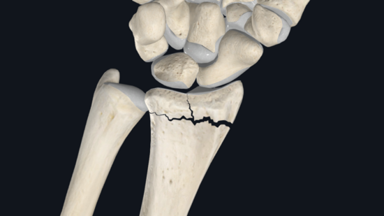 Distal Radius Fractures : OrthoPedia