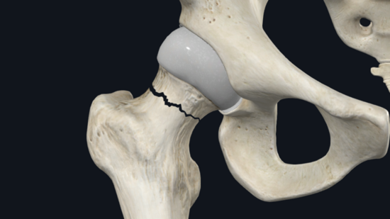 Femoral Neck Fractures : OrthoPedia