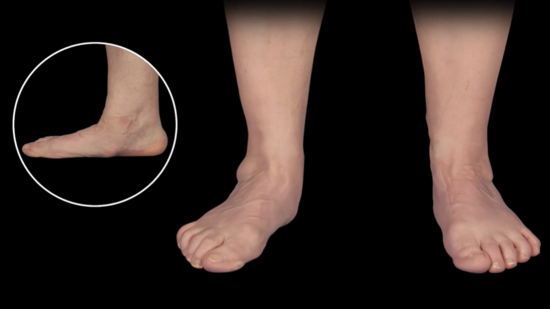Flatfoot Deformities : OrthoPedia