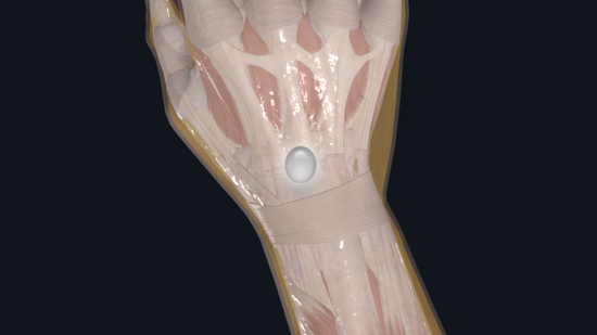 Ganglion Cysts : OrthoPedia