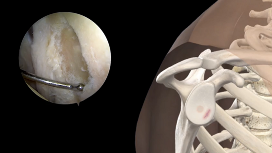 Glenoid Articular Cartilage Defects Orthopedia