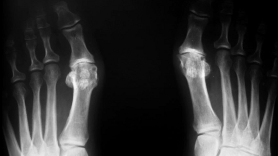 Hallux Rigidus : OrthoPedia