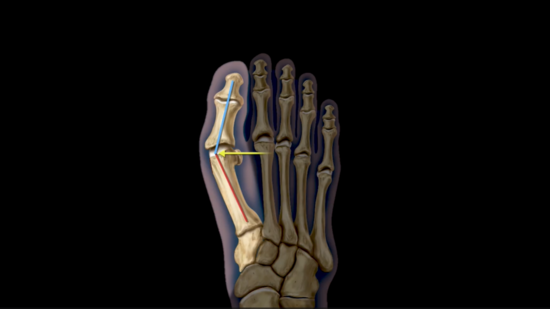 Hallux Valgus : OrthoPedia