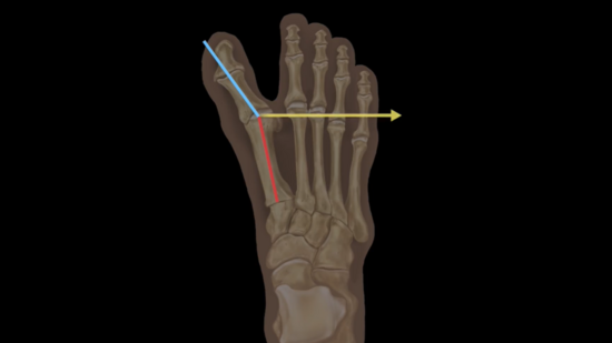 Hallux Varus : OrthoPedia