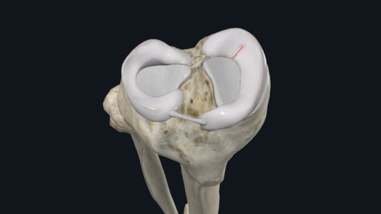 Meniscal Pathologies : OrthoPedia