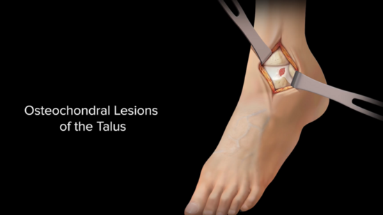 Osteochondral Lesions of the Talus : OrthoPedia