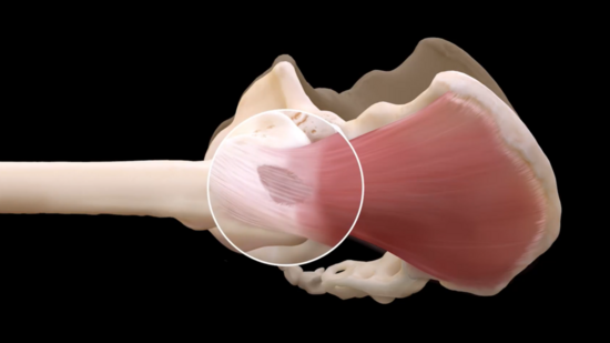 Peritrochanteric Hip Pathologies : OrthoPedia