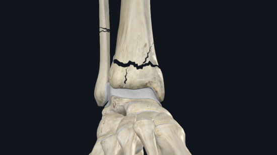 Pilon (Distal Tibia) Fractures : OrthoPedia