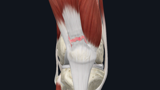Quadriceps Tendon Tears : OrthoPedia