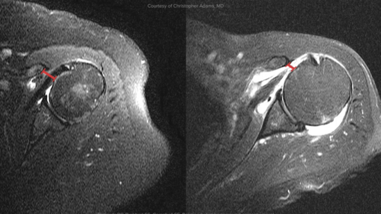 Subscapularis Tendon Tears : OrthoPedia