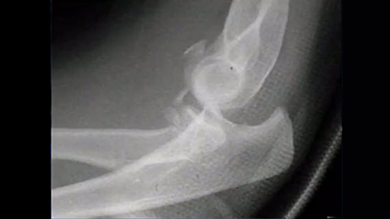 Radial Head Fractures and Terrible Triad Injuries : OrthoPedia