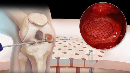 Osteochondral Lesions of the Knee : OrthoPedia