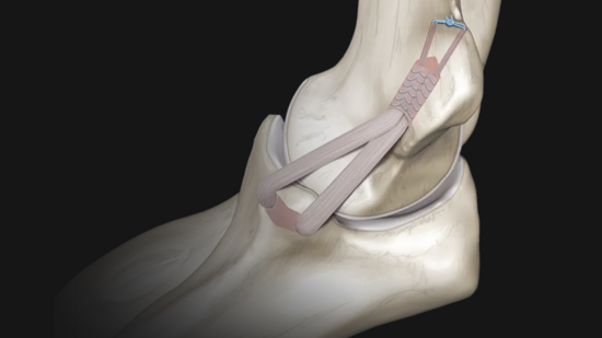 Elbow Graft Harvest and Preparation : OrthoPedia
