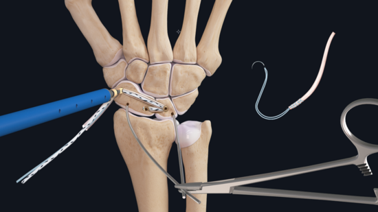 Hand and Wrist Graft Harvest and Preparation : OrthoPedia