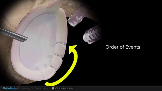 Focus on Chronic Anterior Glenohumeral Joint Instability and Treatment ...