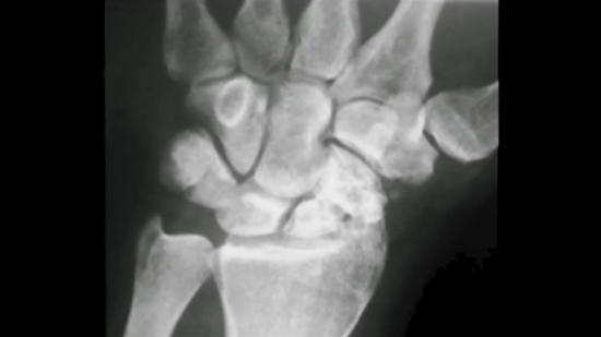 Midcarpal Instability : OrthoPedia