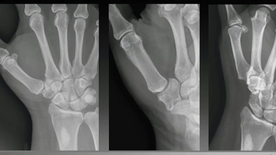 Thumb Pathologies : OrthoPedia