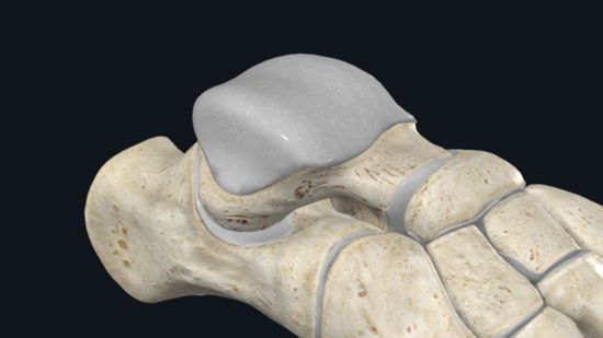 Articular Cartilage Pathologies : OrthoPedia
