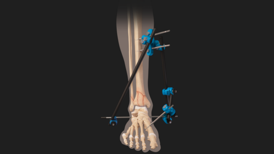 General Trauma : OrthoPedia