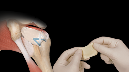 Soft-Tissue Augmentation : OrthoPedia