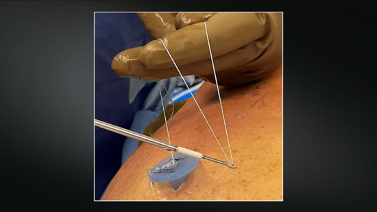 Dr. Suri Demonstrates Tips and Pearls for Rotator Cuff Repair: The ...