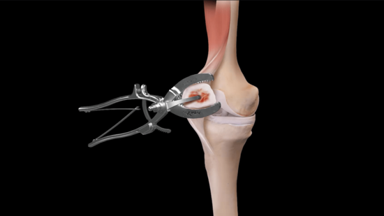 Dr. Farmer Shares Tips and Pearls for Glenohumeral Joint Arthritis ...