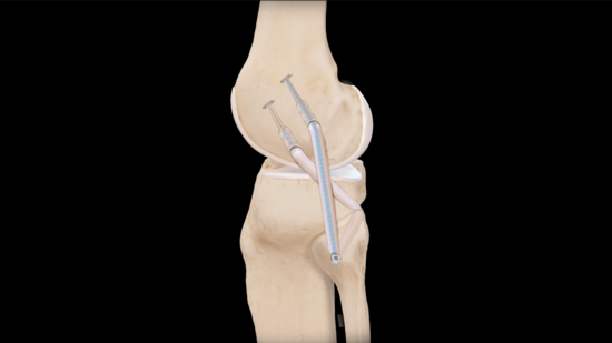 Lateral Collateral Ligament Injuries: Posterolateral Corner (PCL ...