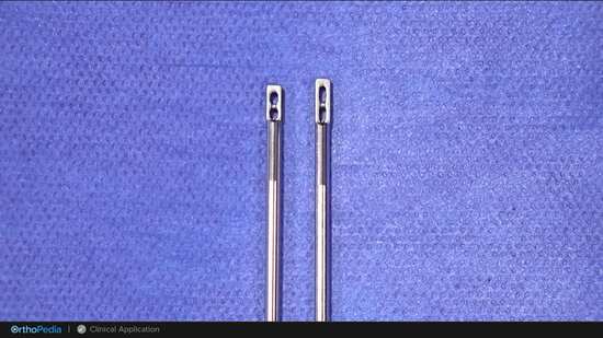 Distal Biceps Tendon Injuries: Single-Incision Distal Biceps Onlay ...