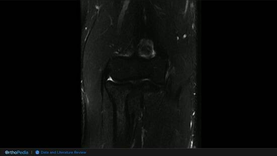 Elbow Medial Ulnar Collateral Ligament (UCL) Injuries: Literature ...