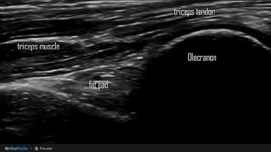 Innovations in Elbow Surgery: Part 6 – Triceps Tendon Injuries : OrthoPedia