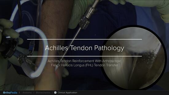 Achilles Tendon Pathology: Achilles Tendon Reinforcement With ...