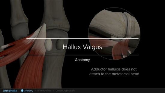 Anatomy of a Foot With Hallux Valgus Deformity : OrthoPedia