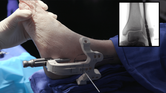 Ankle Fracture and Syndesmosis Injury: Intramedullary Fixation With the ...