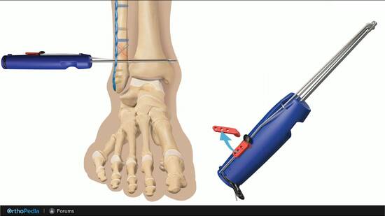 Ankle Fractures in 2020: Part 3—FibuLock® Fibular Nail Technique With ...