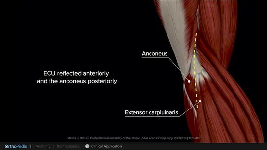Elbow Lateral Collateral Ligament Injuries: General Surgical ...