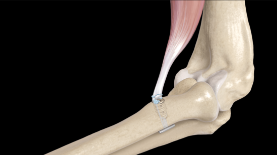 OTIF: Endoscopic-Assisted Distal Biceps Repair With the NanoScope ...