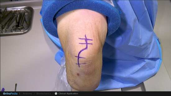 Triceps Tendon Rupture: Distal Triceps Repair With Knotless SwiveLock ...