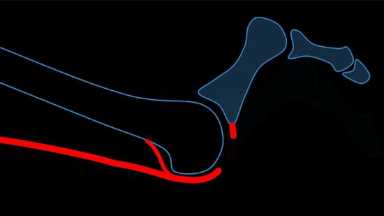 Biomechanics of the Foot With Lesser Toe Pathologies : OrthoPedia