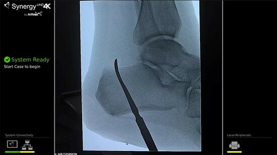 Dr. Acevedo Demonstrates a Tip for Flatfoot Deformity: Identifying the ...