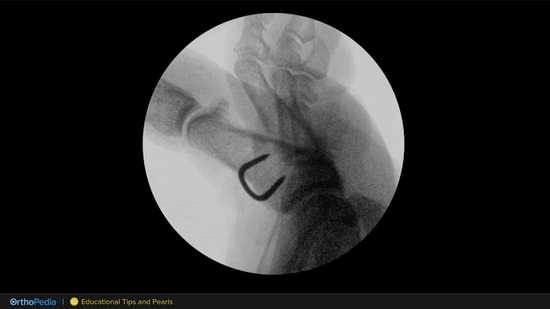 Dr. Harris Demonstrates Tips and Pearls for Hallux Rigidus: A Post ...