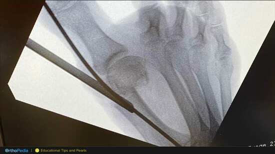 Dr. Harris Demonstrates Tips and Pearls for Hallux Rigidus: Provisional ...