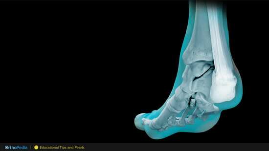Dr. Robinson Demonstrates Tips and Pearls for Achilles Tendon Pathology ...