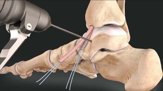 Flatfoot Deformity: Deltoid Ligament Reconstruction With TightRope® RT ...