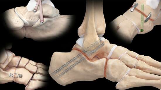 Flatfoot Deformity: General Surgical Considerations With Stages III and ...