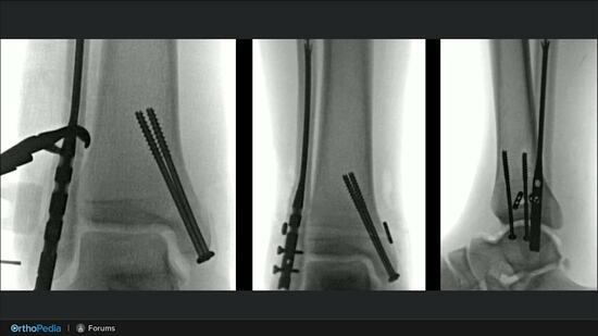 Flexible Syndesmotic Fixation in the Trauma Patient: Part 2—Ankle ...