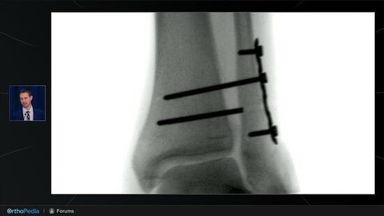 Foot and Ankle Surgery Symposium: Syndesmosis TightRope® Implant: An ...