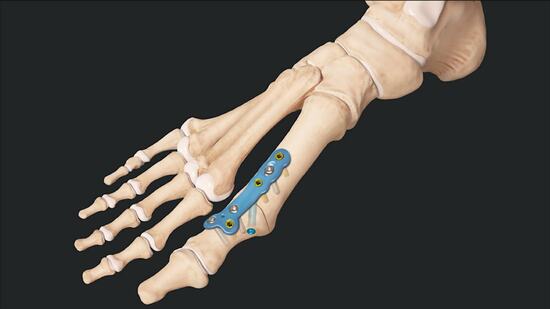 Hallux Valgus: Correction With a 1st Metatarsophalangeal Arthrodesis ...